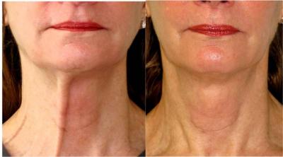 Nefertiti Botox Neck Lift | Skin Ambitions