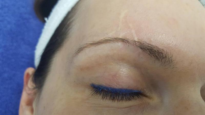 Medical Micropigmentation | Skin Ambitions