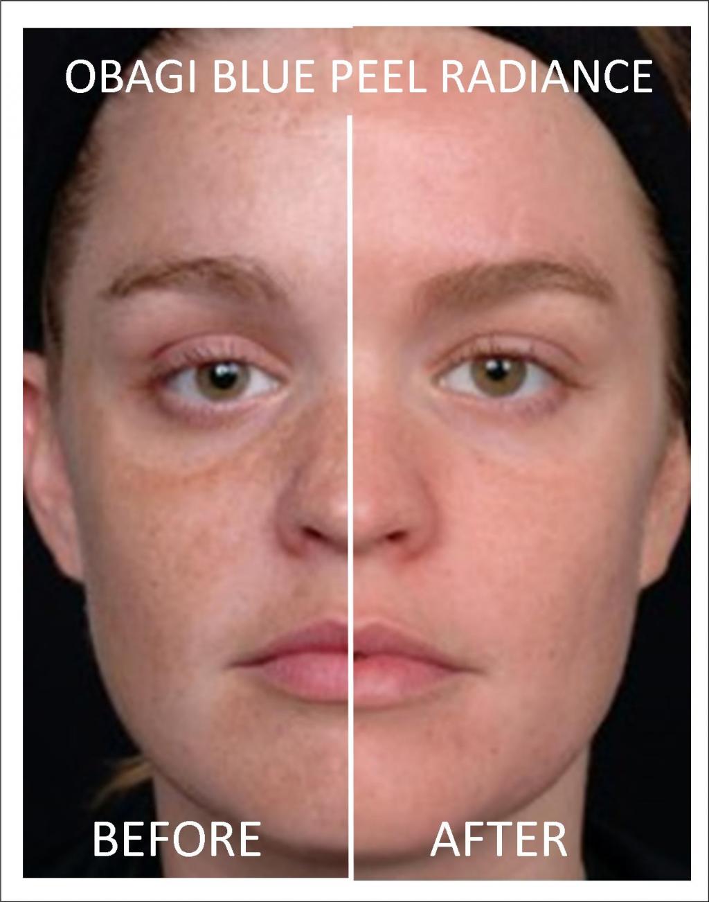 Blue Peel Radiance® Skin Ambitions