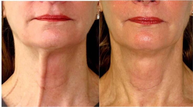 Nefertiti Botox Neck Lift Skin Ambitions