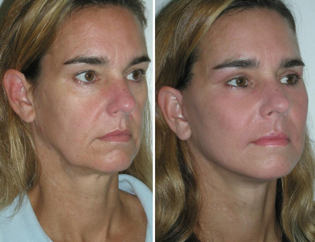 Nefertiti Botox Neck Lift | Skin Ambitions