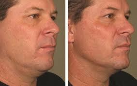 Nefertiti Botox Neck Lift | Skin Ambitions